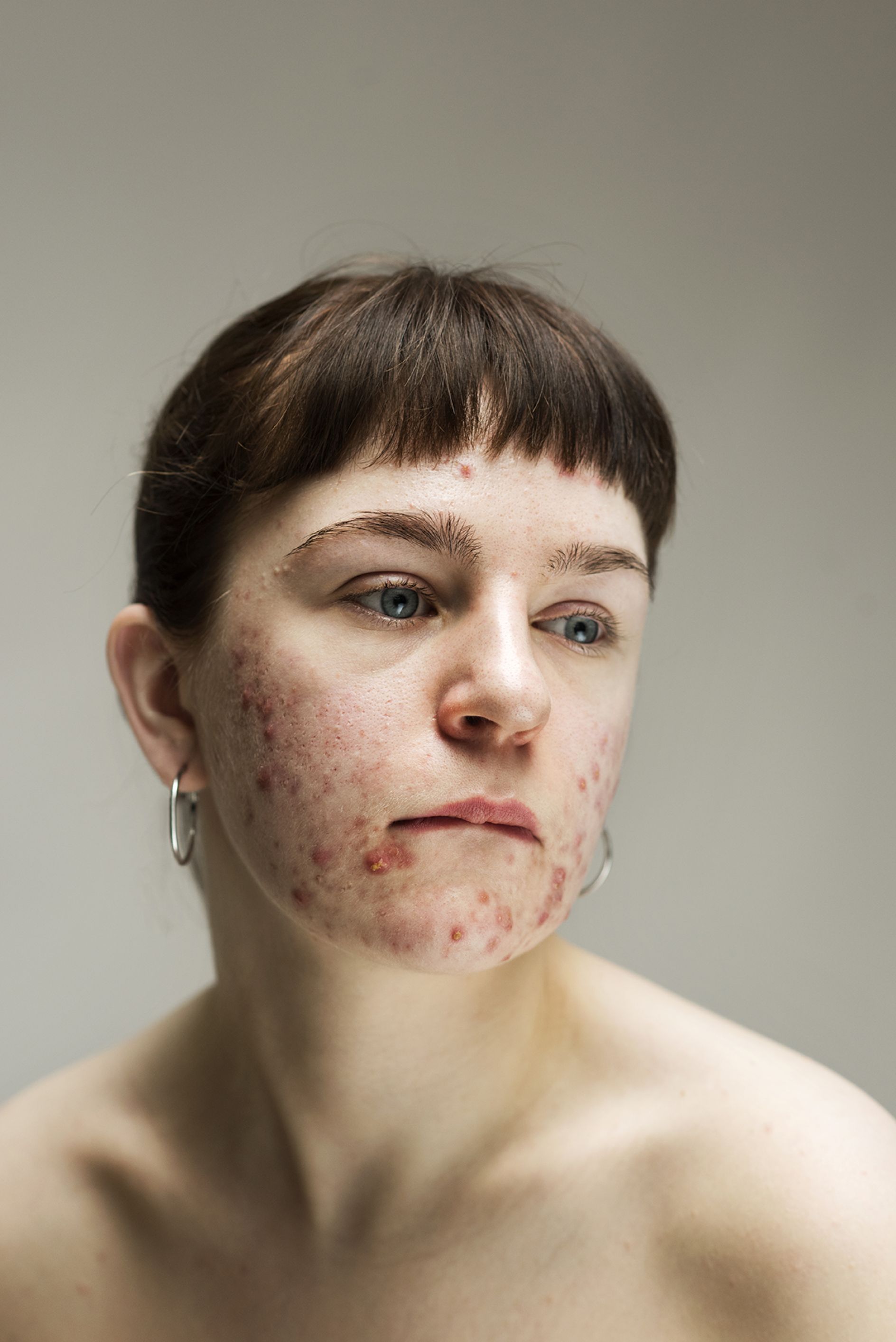 Photographs of bare-faced women with common skin conditions celebrate ...